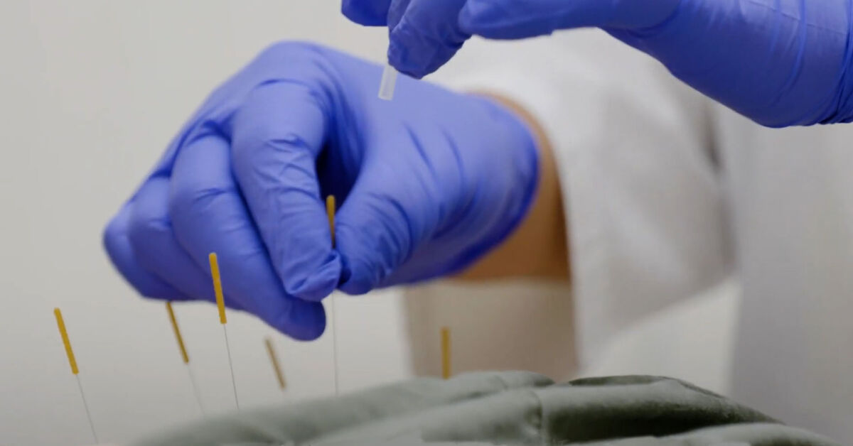 The benefits of acupuncture and how it can relieve your pain | Ochsner ...