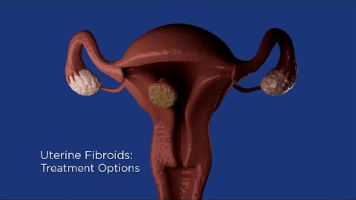 Ochsner Center for Minimally Invasive Treatment of Uterine Fibroids ...