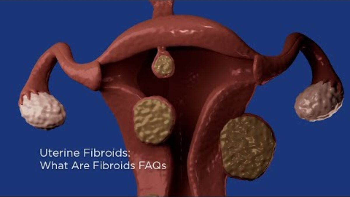 Ochsner Center for Minimally Invasive Treatment of Uterine Fibroids ...
